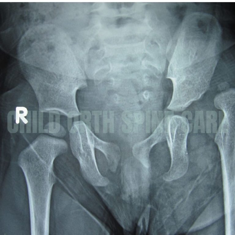 Expert Pediatric Orthopedic Surgeon-Congenital Hip Dislocation