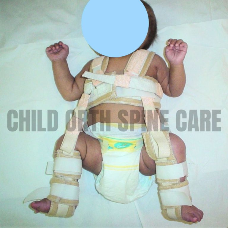 Expert Pediatric Orthopedic Surgeon-Congenital Hip Dislocation