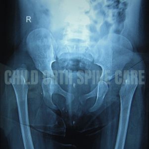 Expert Pediatric Orthopedic Surgeon-Congenital Hip Dislocation