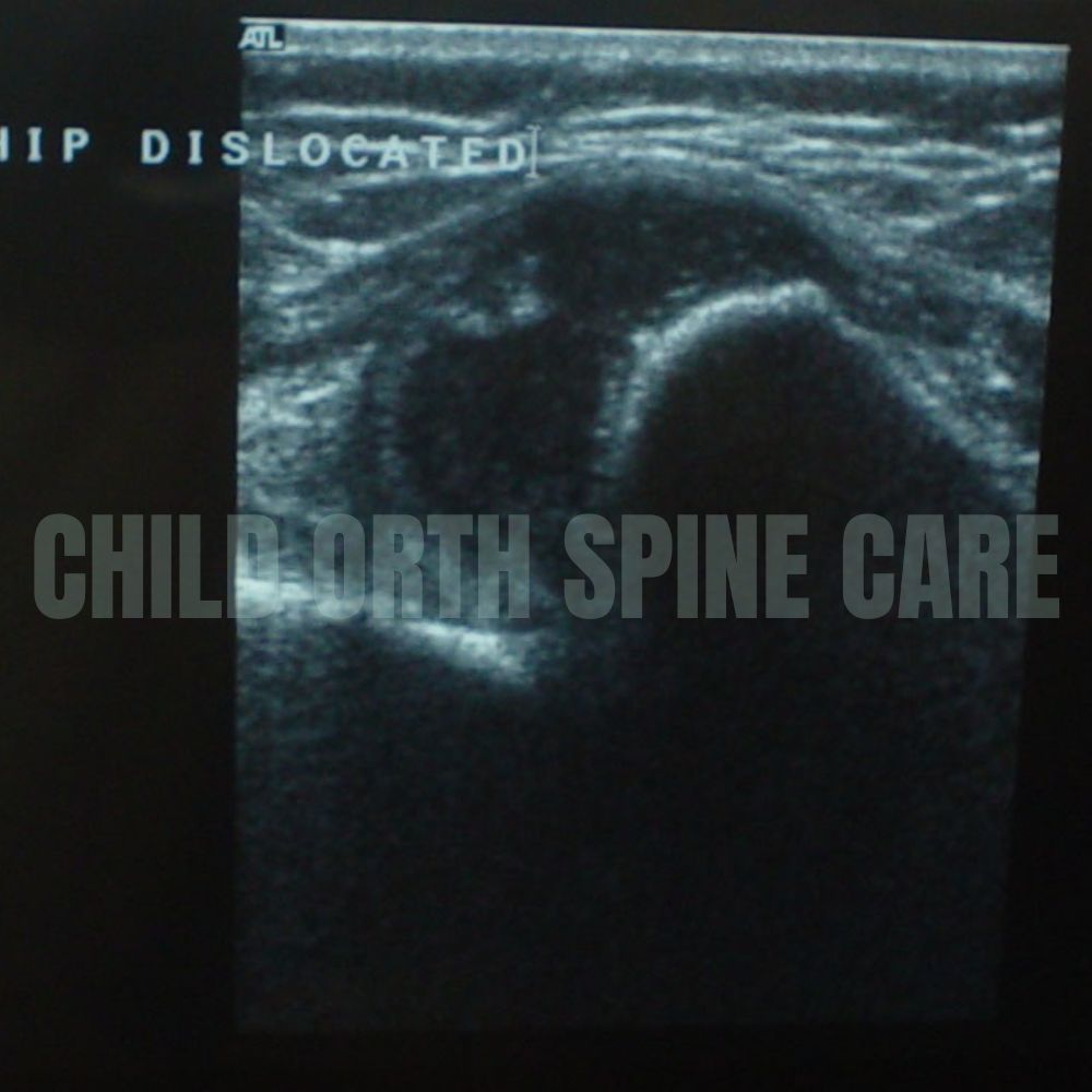 Expert Pediatric Orthopedic Surgeon-Congenital Hip Dislocation