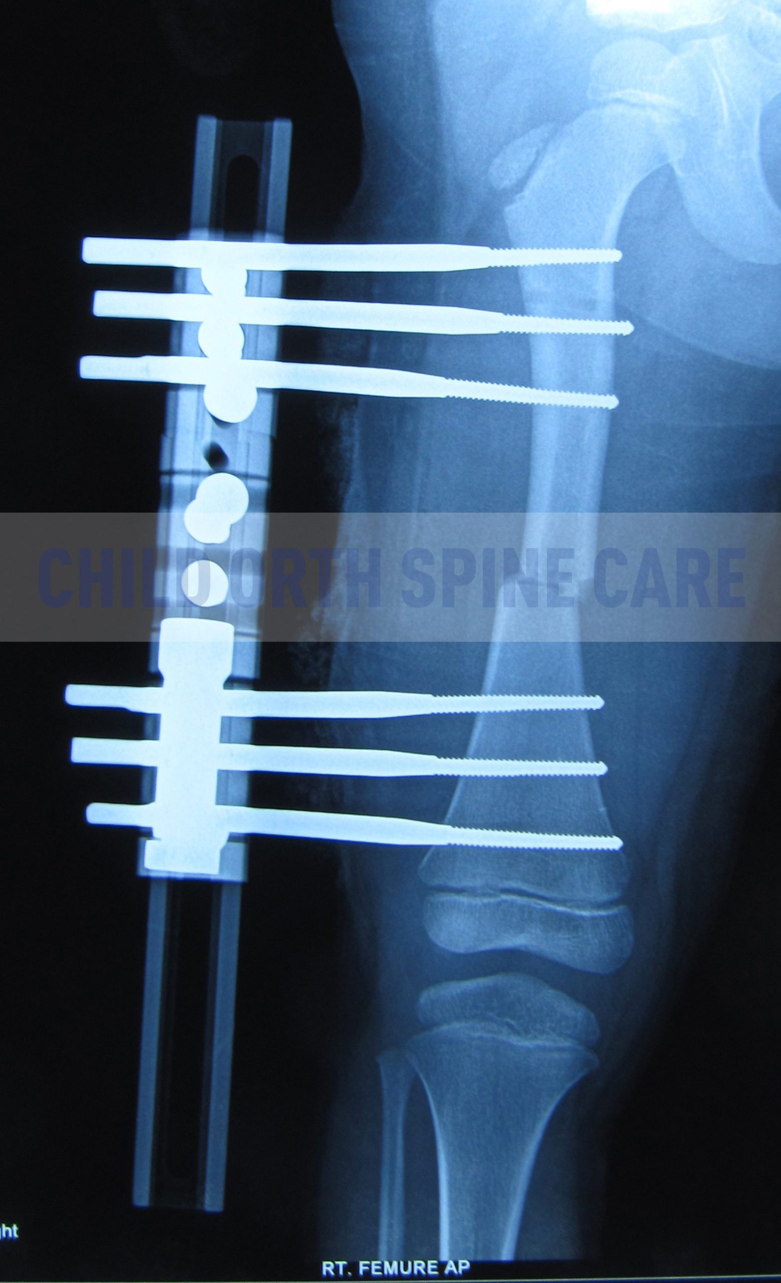 Limb Lengthening & Height Gain Surgery | Dr.Sanjay Sarup