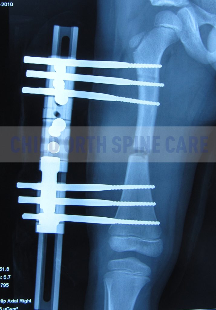 Limb Lengthening & Height Gain Surgery | Dr.Sanjay Sarup