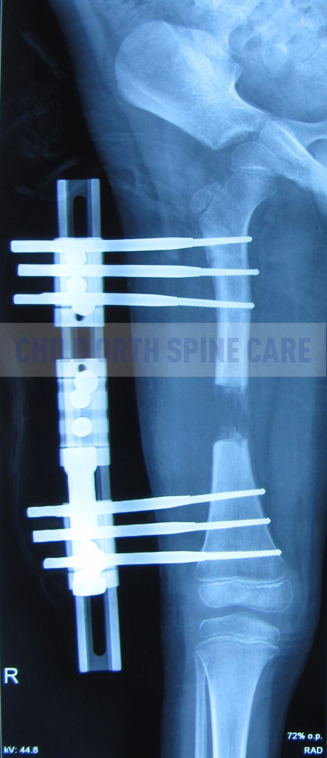 Limb Lengthening & Height Gain Surgery | Dr.Sanjay Sarup