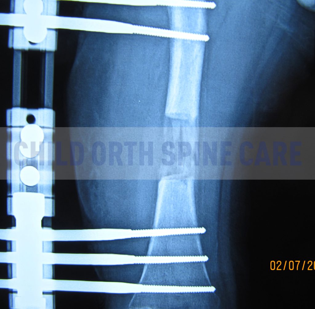 Limb Lengthening & Height Gain Surgery | Dr.Sanjay Sarup