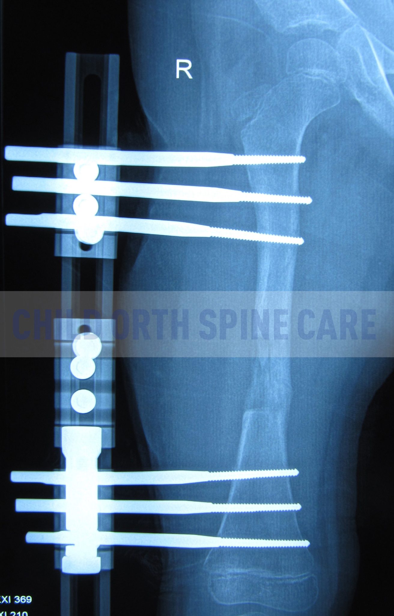 Limb Lengthening & Height Gain Surgery | Dr.Sanjay Sarup
