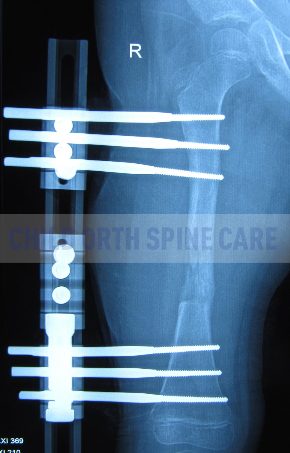 Limb Lengthening & Height Gain Surgery | Dr.Sanjay Sarup