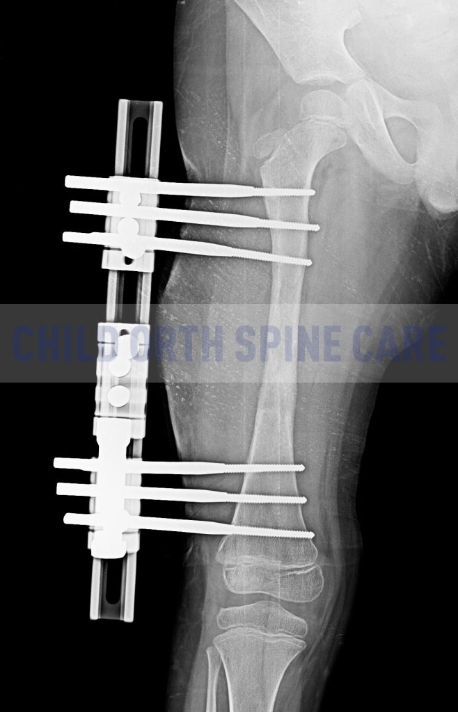 Limb Lengthening & Height Gain Surgery | Dr.Sanjay Sarup