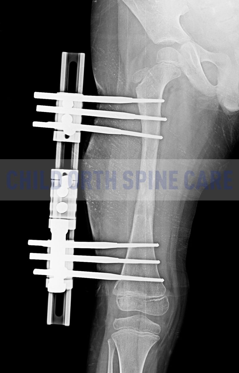 Limb Lengthening & Height Gain Surgery | Dr.Sanjay Sarup