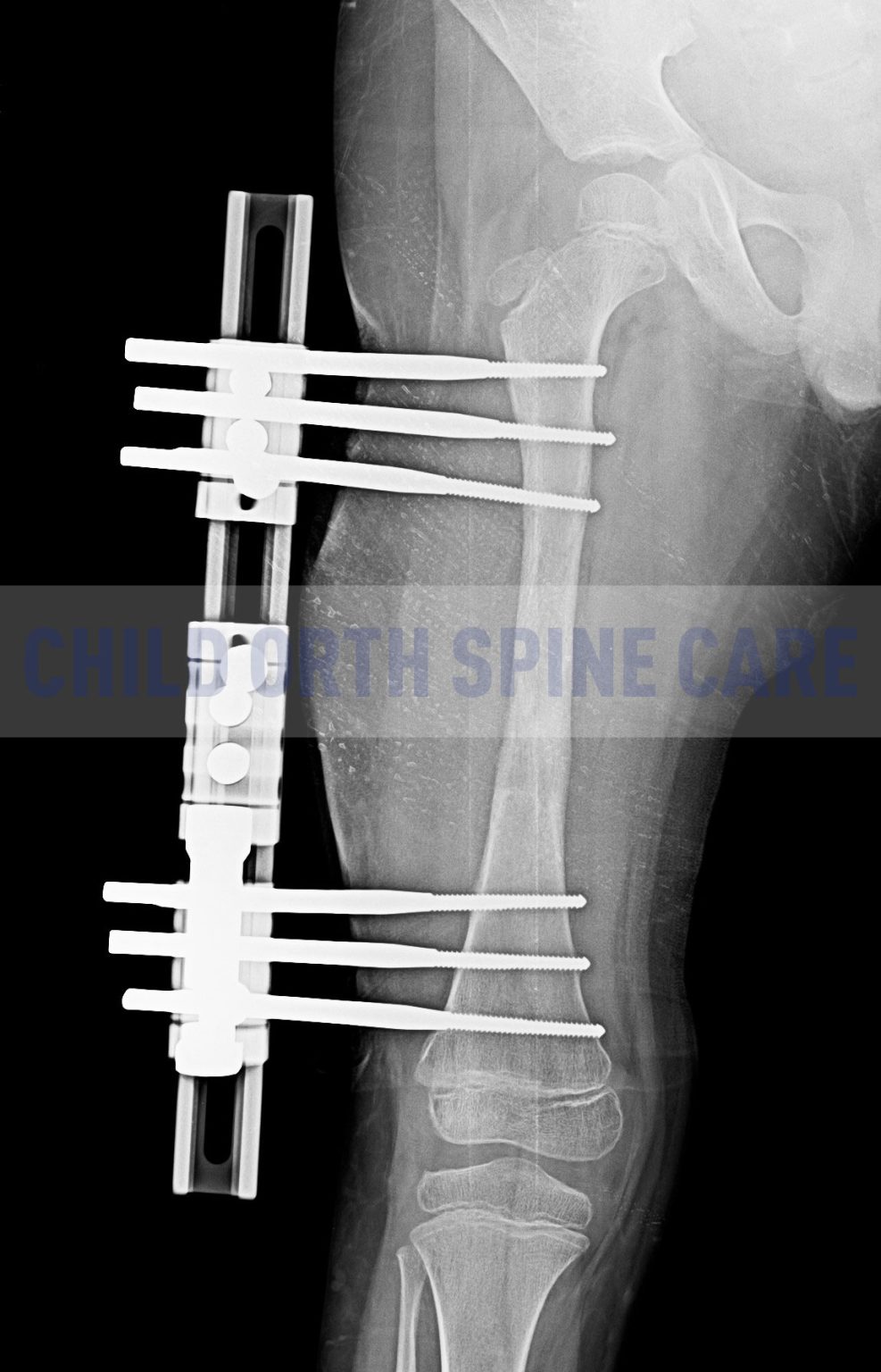 Limb Lengthening & Height Gain Surgery | Dr.Sanjay Sarup