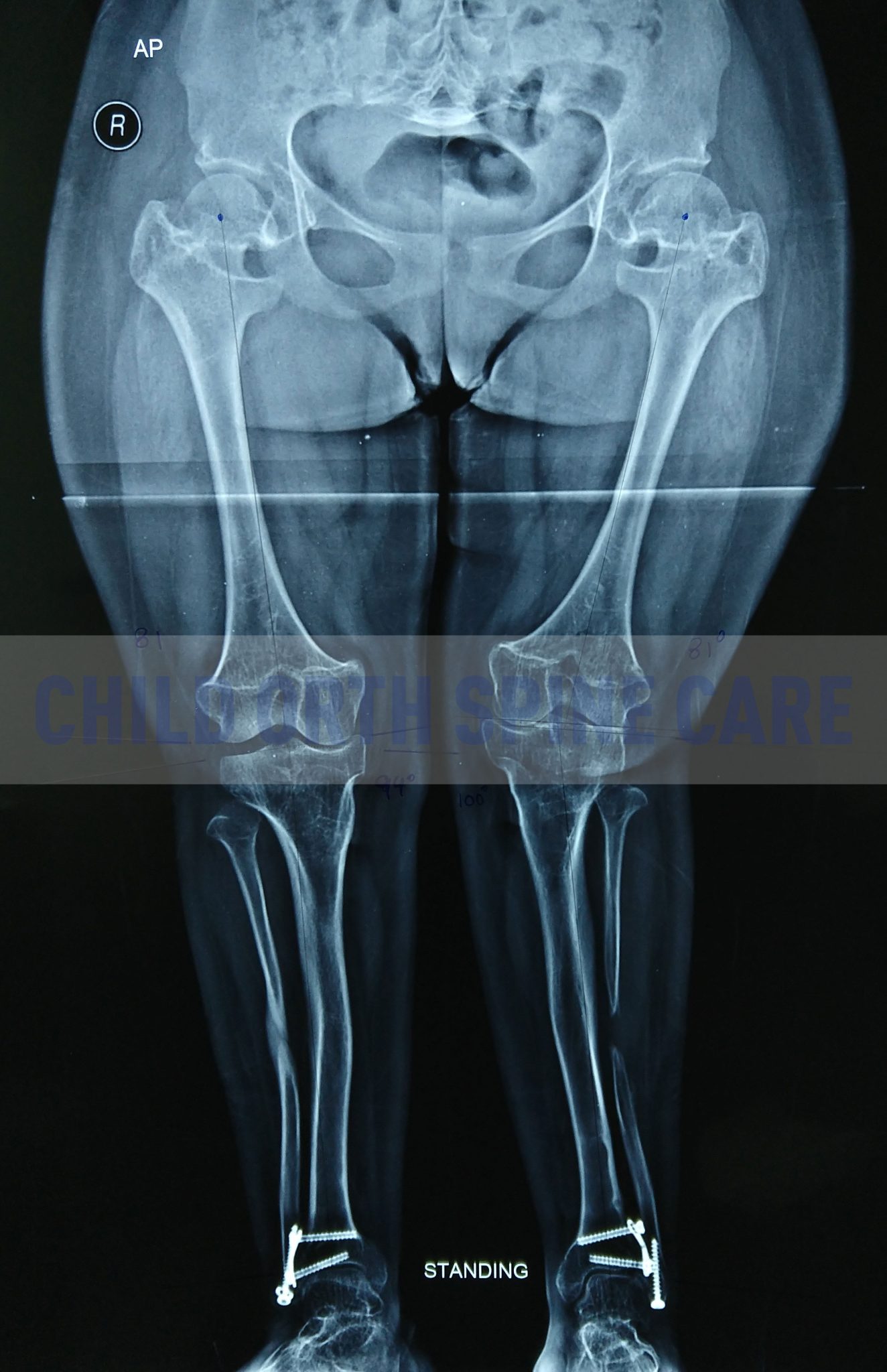 Limb Lengthening & Height Gain Surgery | Dr.Sanjay Sarup