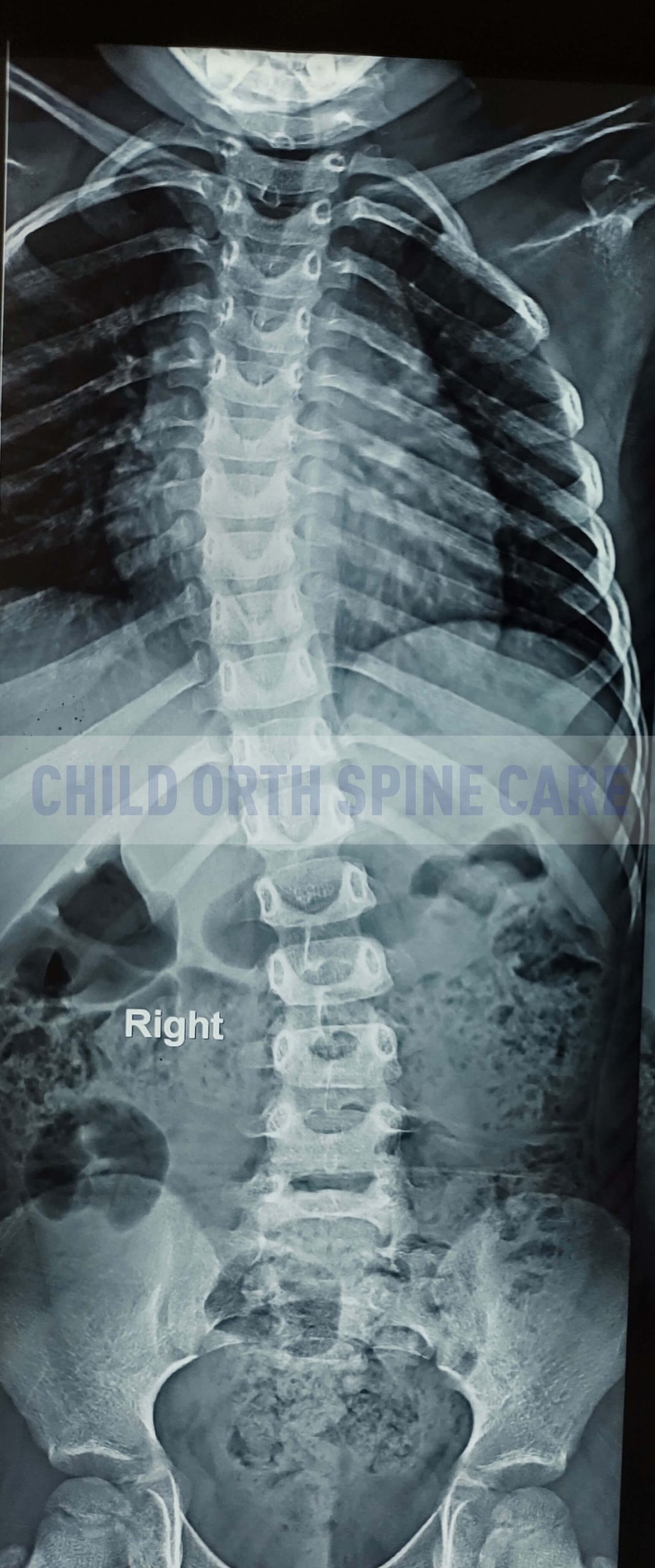 Scoliosis Treatment Without Surgery - Dr. Sanjay Sarup