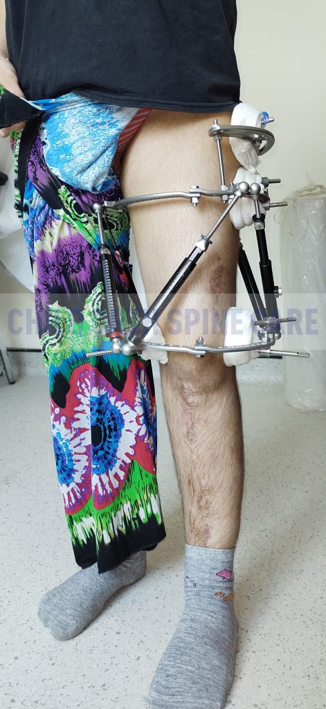 Limb Lengthening & Height Gain Surgery | Dr.Sanjay Sarup