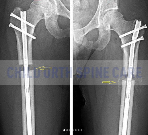 Limb Lengthening & Height Gain Surgery | Dr.Sanjay Sarup