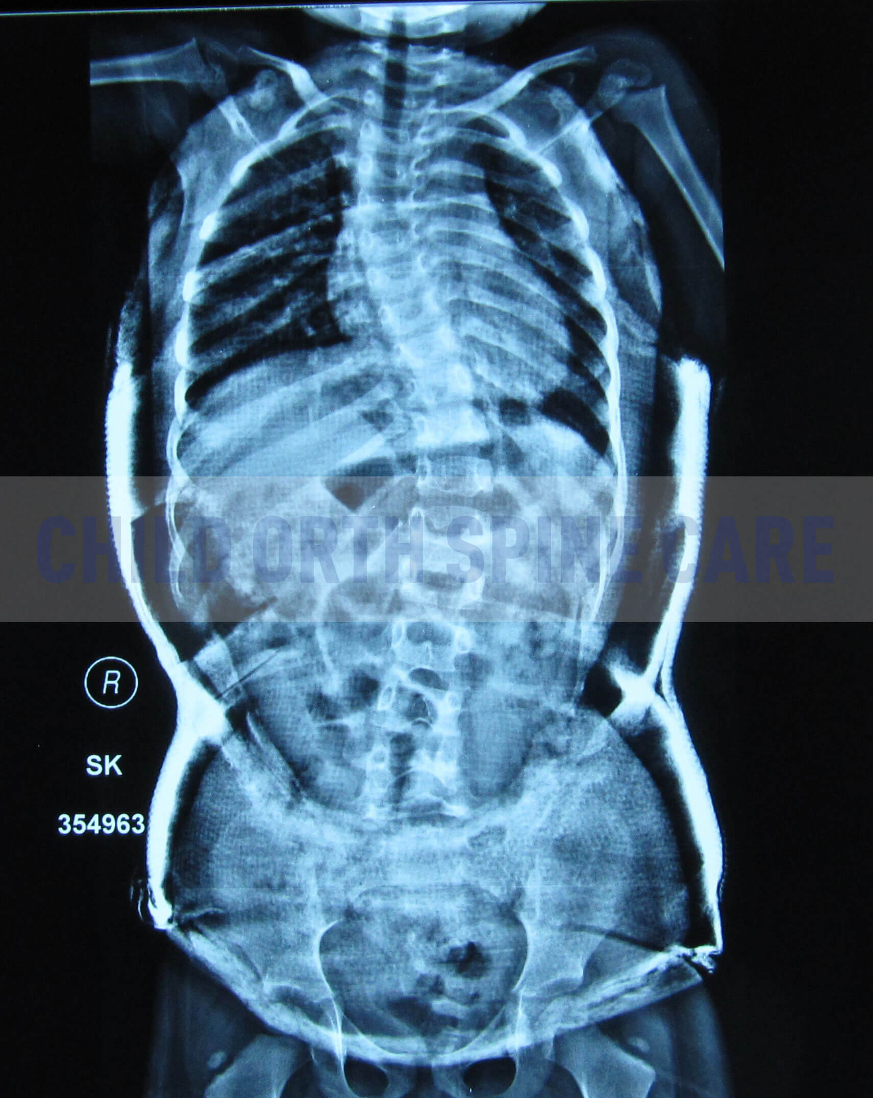 Scoliosis Treatment Without Surgery - Dr. Sanjay Sarup
