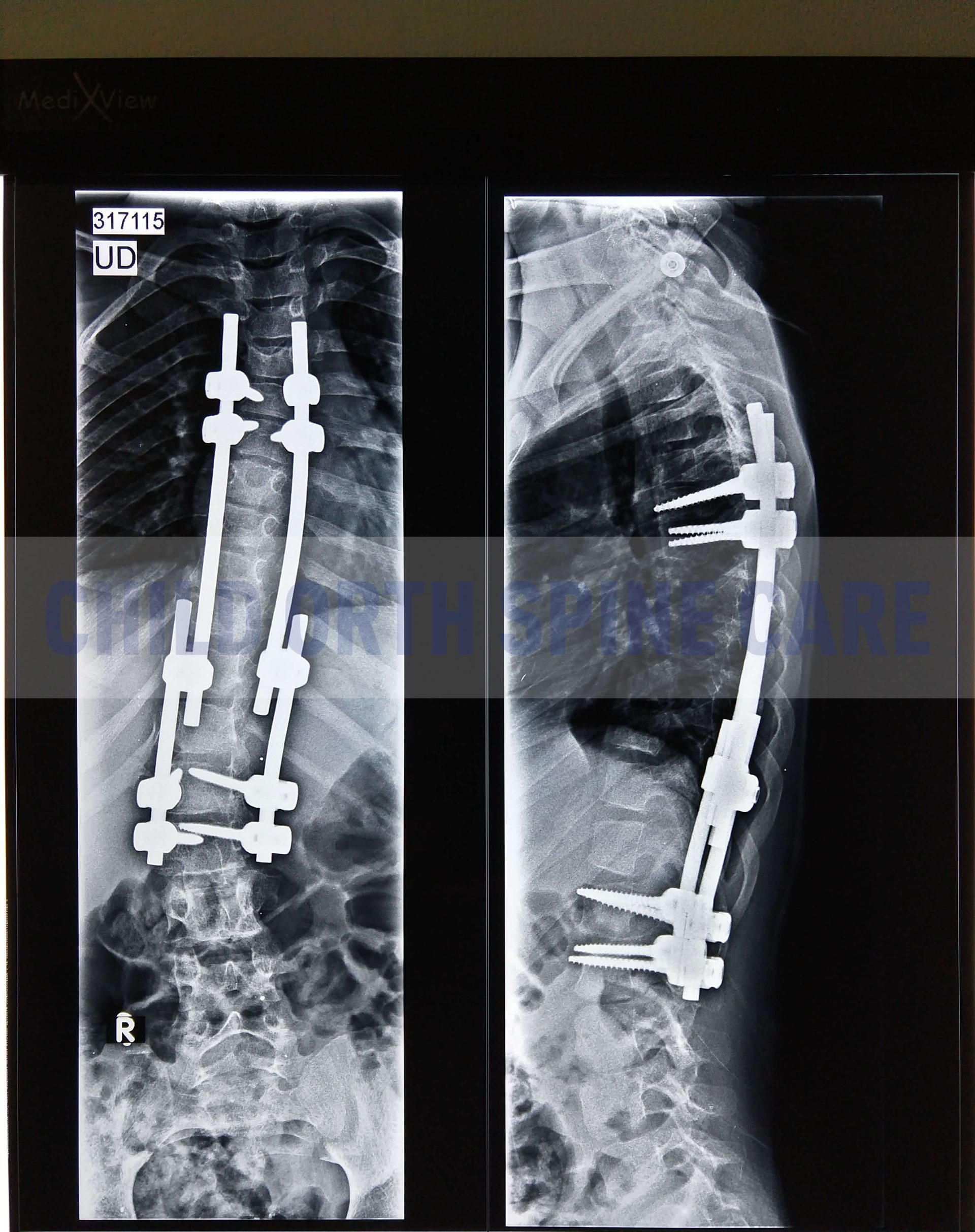 Scoliosis Treatment Without Surgery - Dr. Sanjay Sarup