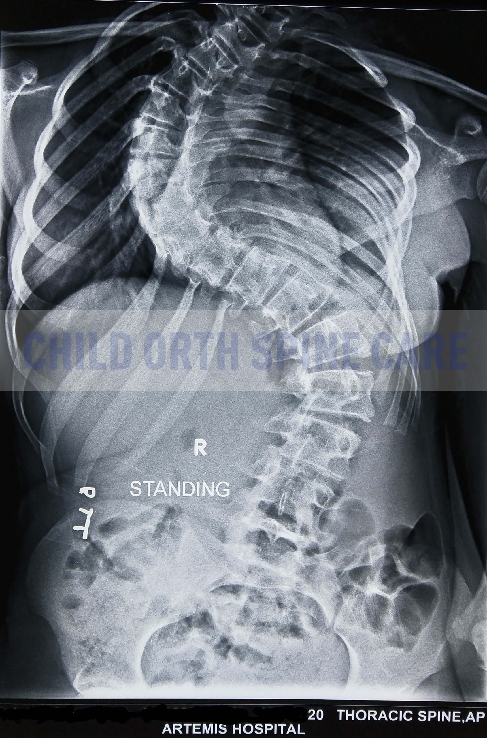 Spine Deformity Surgery in Gurgaon | Child Scoliosis Treatment in Gurgaon