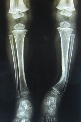 CONGENITAL PSEUDOARTHROSIS OF TIBIA - Children’s Orthopaedic & Spine ...