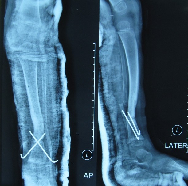 CONGENITAL PSEUDOARTHROSIS OF TIBIA - Children’s Orthopaedic & Spine ...