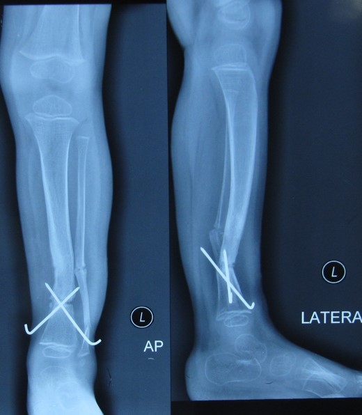 CONGENITAL PSEUDOARTHROSIS OF TIBIA - Children’s Orthopaedic & Spine ...