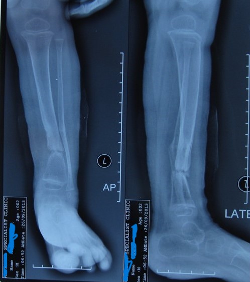 CONGENITAL PSEUDOARTHROSIS OF TIBIA - Children’s Orthopaedic & Spine ...