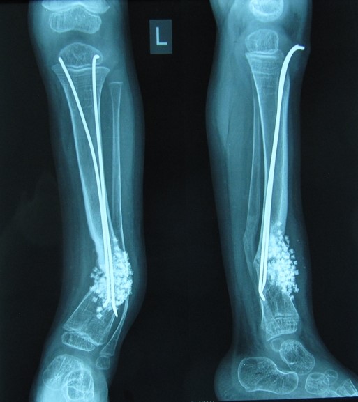 CONGENITAL PSEUDOARTHROSIS OF TIBIA - Children’s Orthopaedic & Spine ...