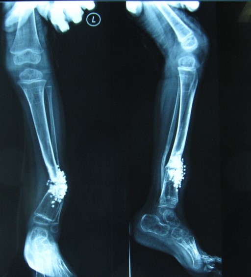 CONGENITAL PSEUDOARTHROSIS OF TIBIA - Children’s Orthopaedic & Spine ...