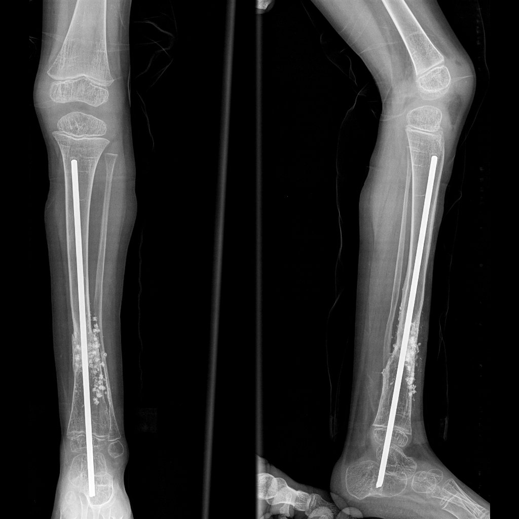 CONGENITAL PSEUDOARTHROSIS OF TIBIA - Children’s Orthopaedic & Spine ...