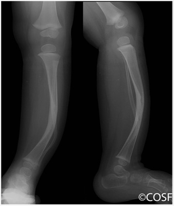 CONGENITAL PSEUDOARTHROSIS OF TIBIA - Children’s Orthopaedic & Spine ...