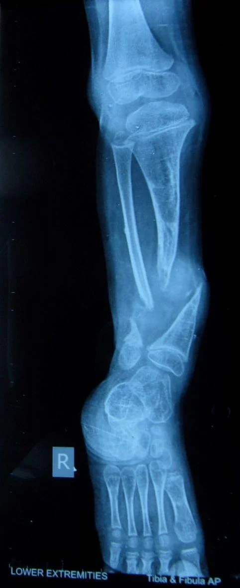 tibia pseudoarthrosis